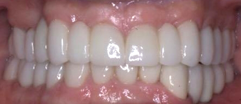 Full Mouth Dental Implants | Cincinnati, OH | Hebron | Cold Spring, KY