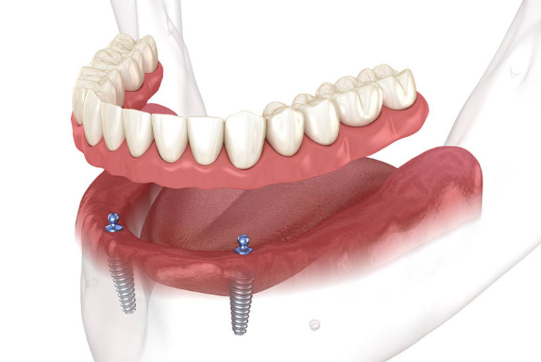 Implant Supported Dentures | Cincinnati, OH | Hebron | Cold Spring, KY